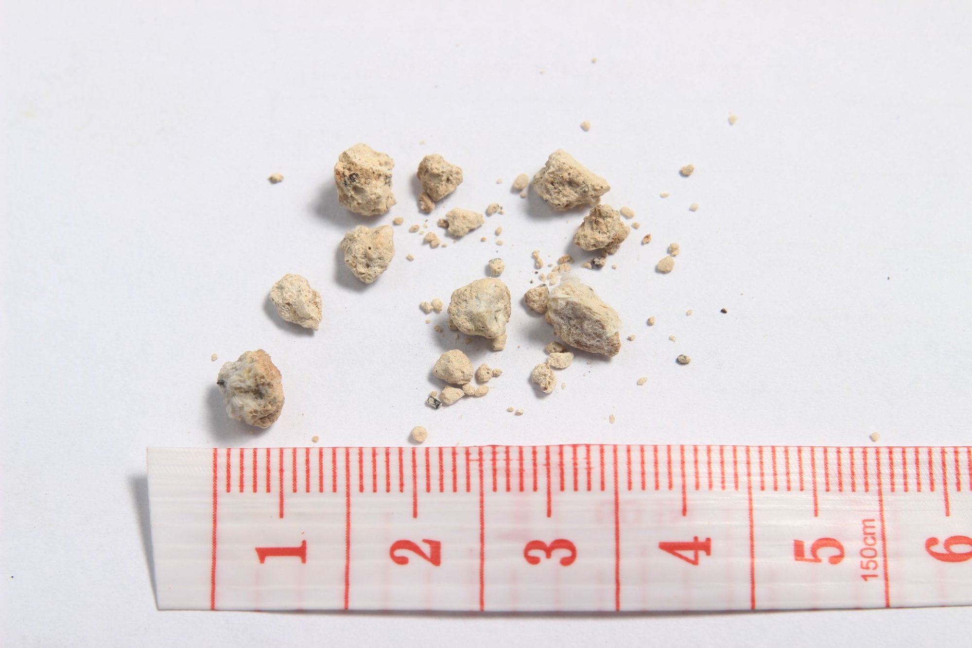 Pedra no Rim: Tamanho e Cirurgia